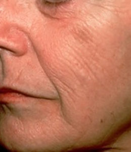 CO2RE and UltraPulse Active FX Deep FX Lasers - Main Line for Laser ...